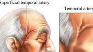 Arterite temporal - Neurocirurgia